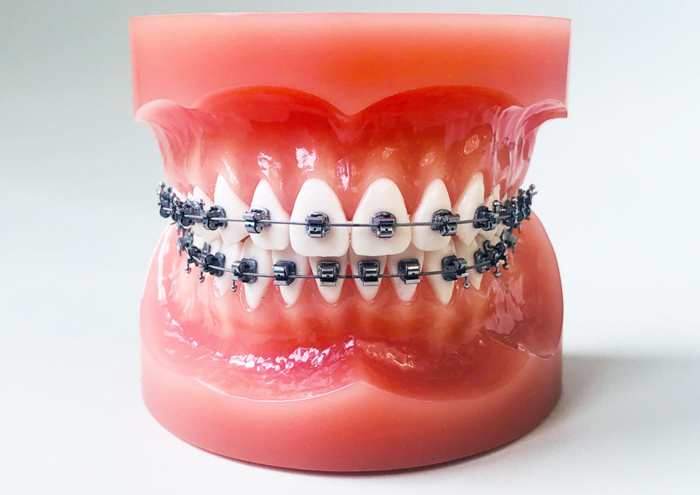 Mini-Brackets - Kieferorthopädie in Unna, Bönen & Letmathe | KFO Dr. Gette